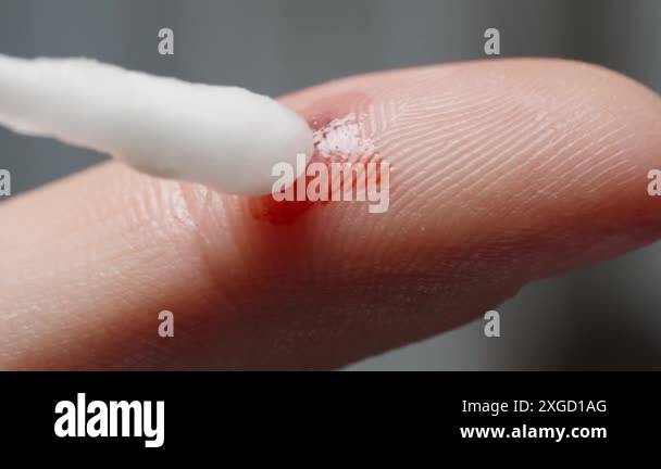 Peroxide solution Stock Videos & Footage - HD and 4K Video Clips - Alamy