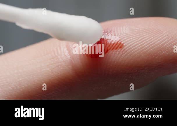 Bubbles wound Stock Videos & Footage - HD and 4K Video Clips - Alamy