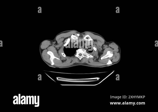 High-Resolution Chest CT Scan (HRCT) of the Thorax Stock Video Footage ...