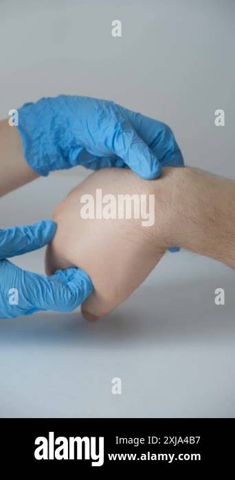 Ganglion cyst or hygroma of the wrist on the hand of a male patient ...