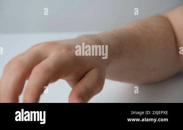 Ganglion cyst or hygroma of the wrist on the hand of a male patient ...