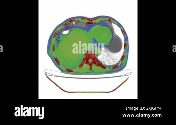 Coloured computed tomography (CT) scan of a 60 year old male patient ...