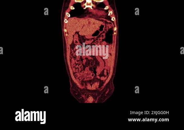 Coloured computed tomography (CT) scan of a 60 year old male patient ...