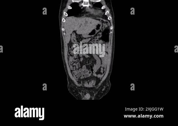 Computed tomography (CT) scan of a 60 year old male patient with ...