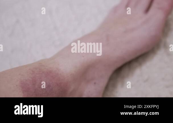 Close up, Formation of a Large Red Spot on the Skin from a Tick Bite ...