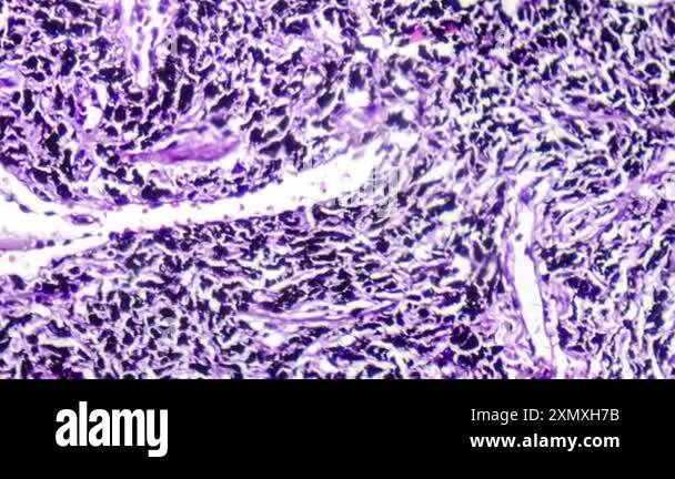 Smokers lung tissue,Light microscopy of a smokers lung tissue. Smoking ...