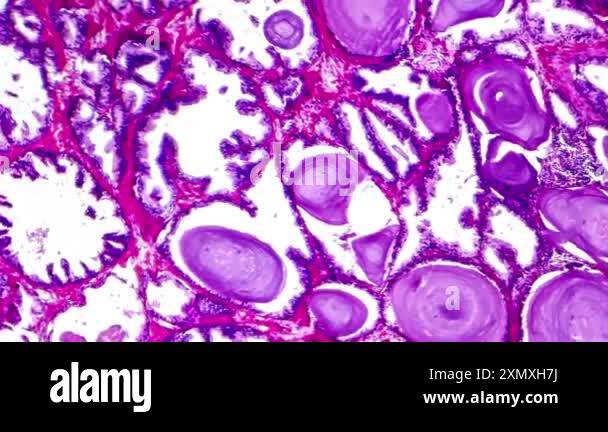 Light microscopy of tissue of a patient with benign prostatic ...