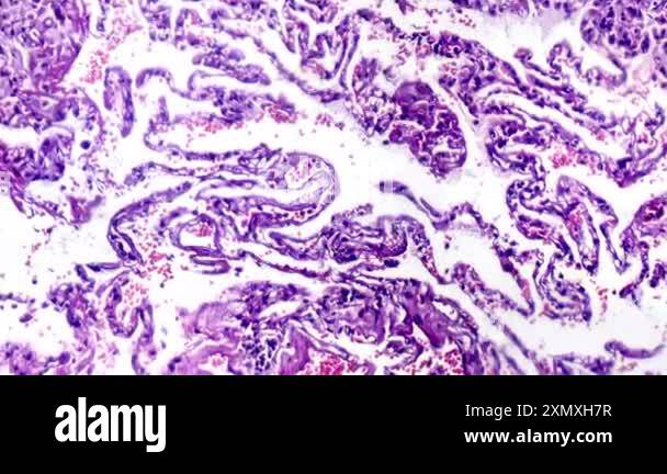 Smokers lung tissue,Light microscopy of a smokers lung tissue. Smoking ...