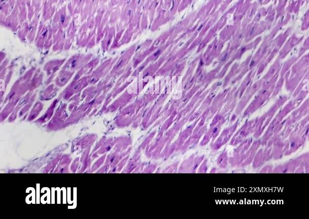 Light microscopy of the heart tissue of a patient with heart ...