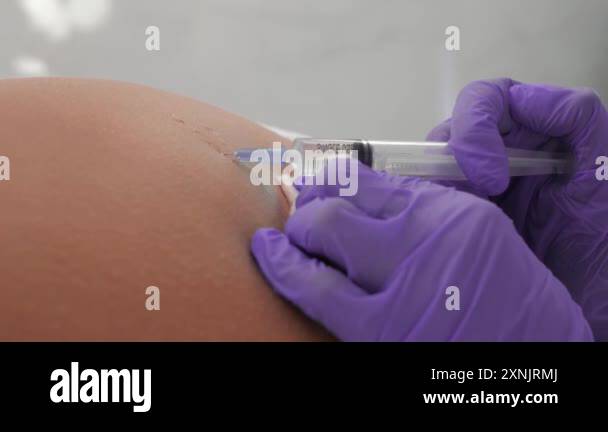 Procedure for removing stretch marks on the skin with injections in a ...
