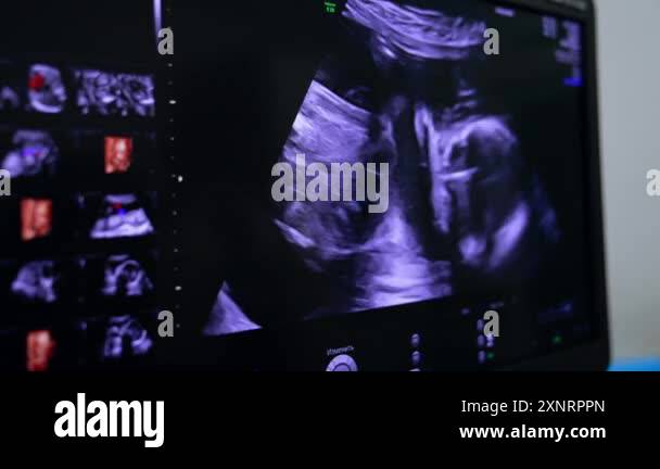 Baby patient congenital birth Stock Videos & Footage - HD and 4K Video ...