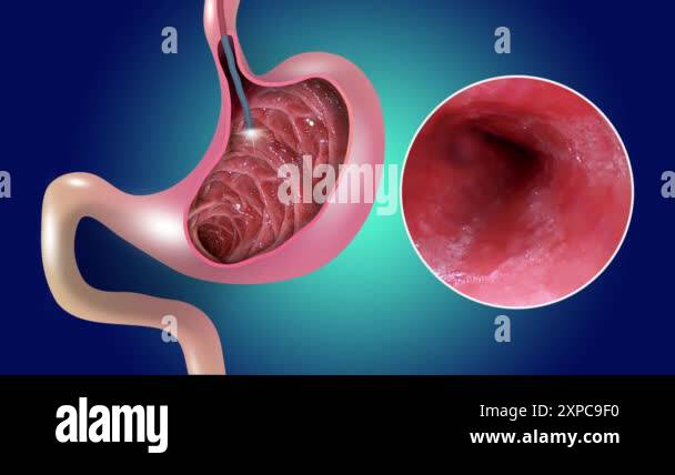 2D animation. Gastric mucosa. Digestive endoscopy or gastroscopy ...