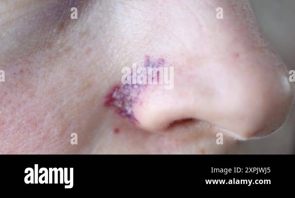 Rosacea red skin rash Stock Videos & Footage - HD and 4K Video Clips ...