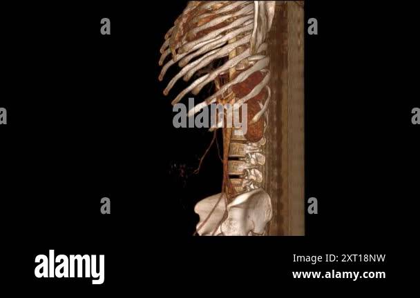 3D CT Scan of Lumbar Spine with Rotating Image on Monitor Stock Video ...