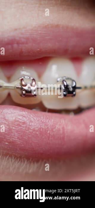 Vertical brackets Stock Videos & Footage - HD and 4K Video Clips - Alamy