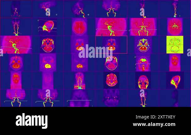 Magnetic resonance images of the brain MRI of the brain of a patient ...