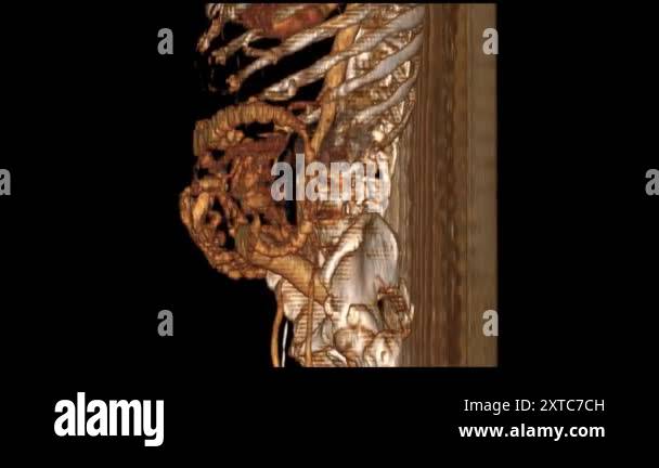 3D Rotating View of Abdomen CT Scan: Detailed Diagnostic Imaging Stock ...
