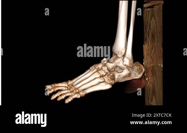 Ct scan leg Stock Videos & Footage - HD and 4K Video Clips - Alamy