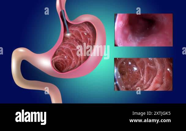 2D animation. Gastric mucosa. Digestive endoscopy or gastroscopy ...