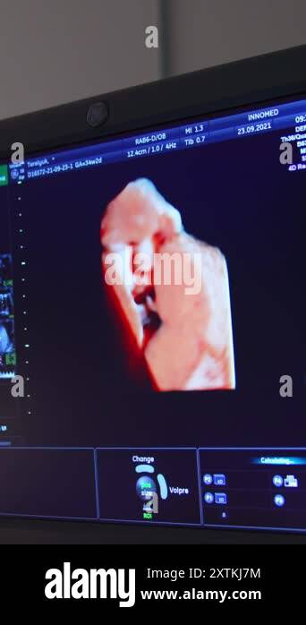 Baby seen on the screen of ultrasound examination apparatus. Close up ...