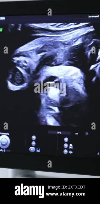 Screen of an ultrasound machine during the pregnant female check ...