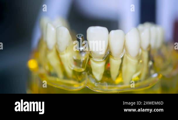 Transparent Model of Human Teeth with implants close-up. Dental implant ...