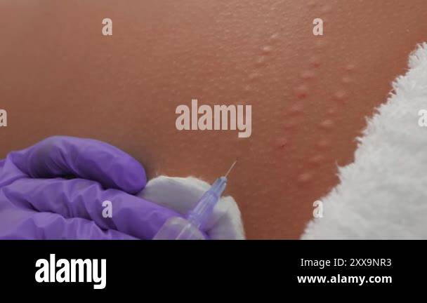 Aesthetic procedure for removing striae with a syringe, performed by a ...