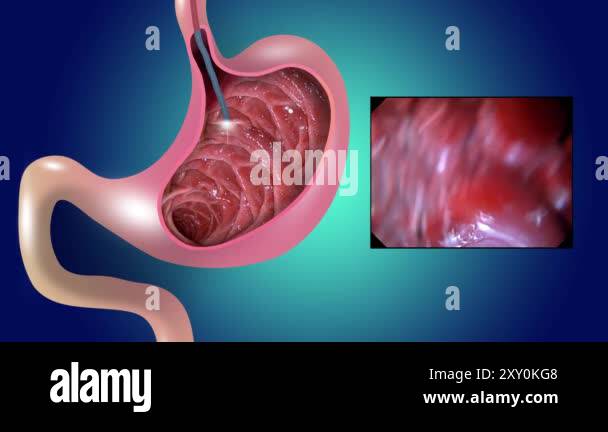 2D animation. Gastric mucosa. Digestive endoscopy or gastroscopy ...