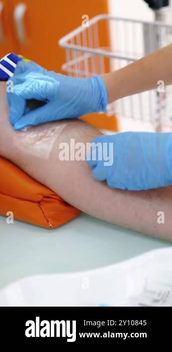 Close up process of taking blood. Process of blood sampling from the ...