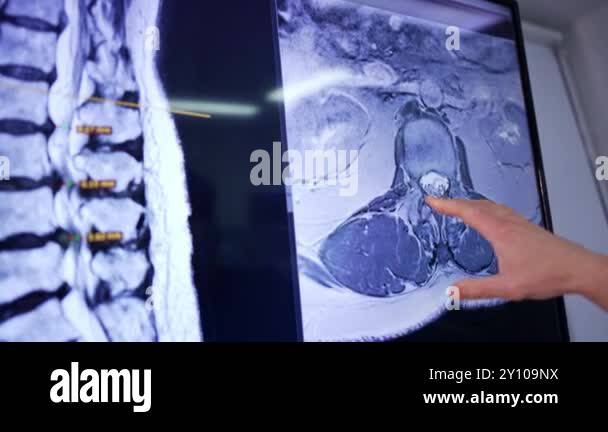 Male doctor's hand pointing at the MRI scan of a patient. Surgeon ...