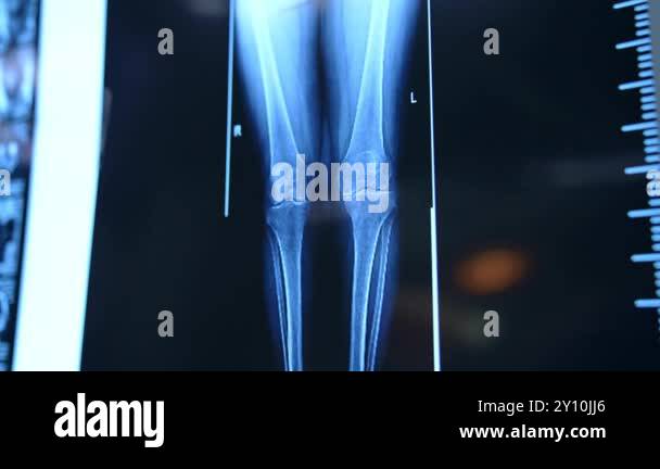 X-ray scan of two legs on the screen. Close up. Orthopedic surgery in ...