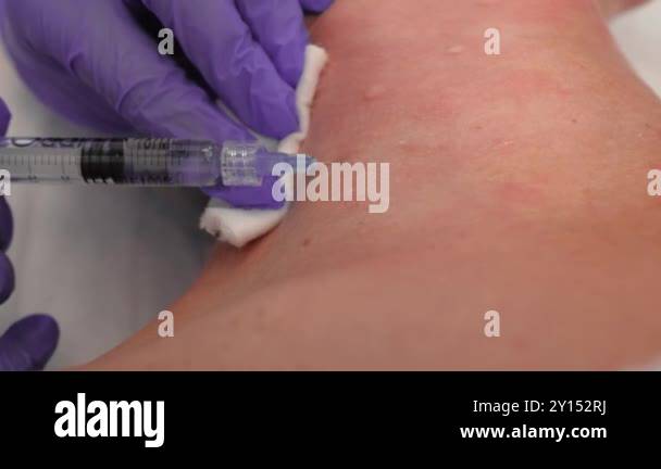 Treatment of neck skin by injection method, performed with sterile ...