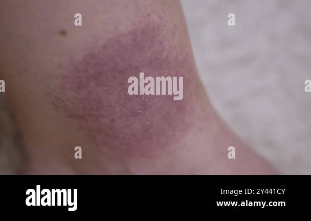 Close up, Formation of a Large Red Spot on the Skin from a Tick Bite ...
