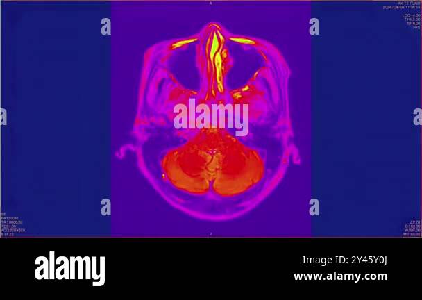Magnetic resonance images of the brain, MRI of the brain, of a patient ...