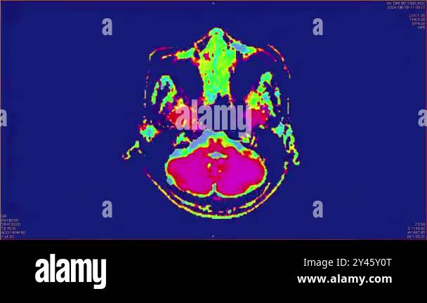 Magnetic resonance images of the brain, MRI of the brain, of a patient ...