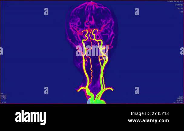 Magnetic resonance images of the brain, MRI of the brain, of a patient ...