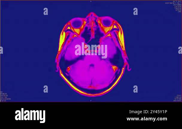 Magnetic resonance images of the brain, MRI of the brain, of a patient ...