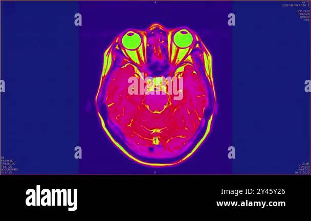 Magnetic resonance images of the head, MRI of the brain, of a patient ...