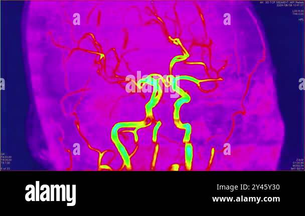 Magnetic resonance images of the brain, MRI of the brain, of a patient ...