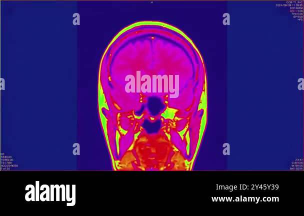 Magnetic resonance images of the brain, MRI of the brain, of a patient ...
