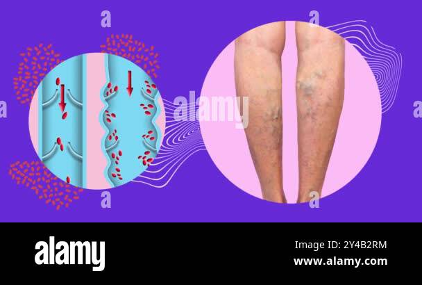 Varicose veins on a female senior legs. The structure of normal and ...