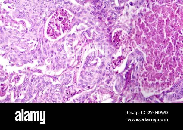 Light microscopy of lung adenocarcinoma, a malignant tumor originating ...
