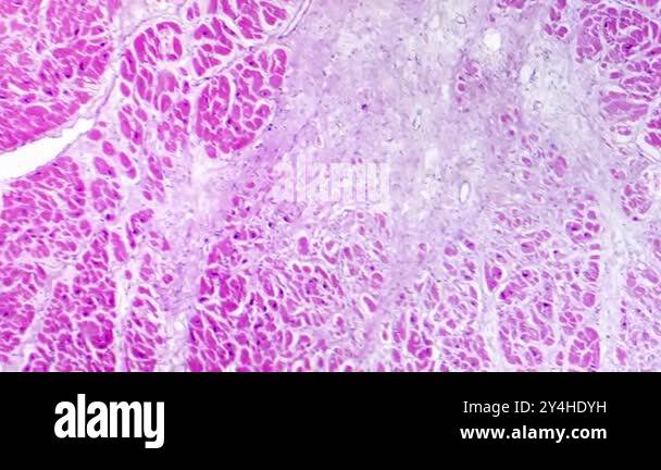 Myocardial infarction, light microscopy showing damaged heart tissue ...