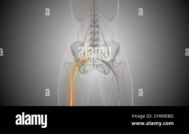 Sciatica causes lower back and leg pain Stock Video Footage - Alamy