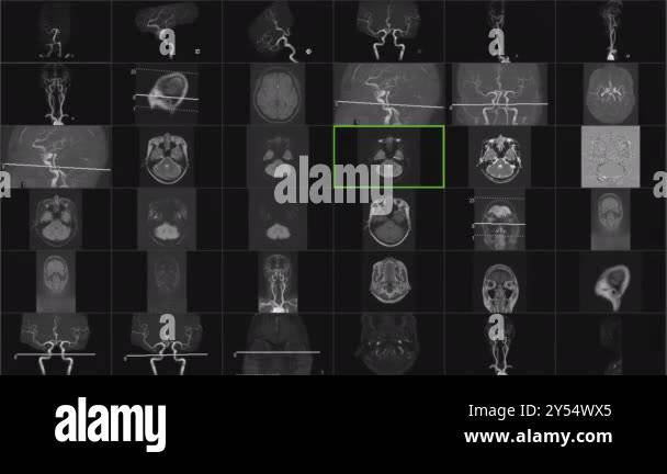 Magnetic resonance images of the brain MRI of the brain of a patient ...