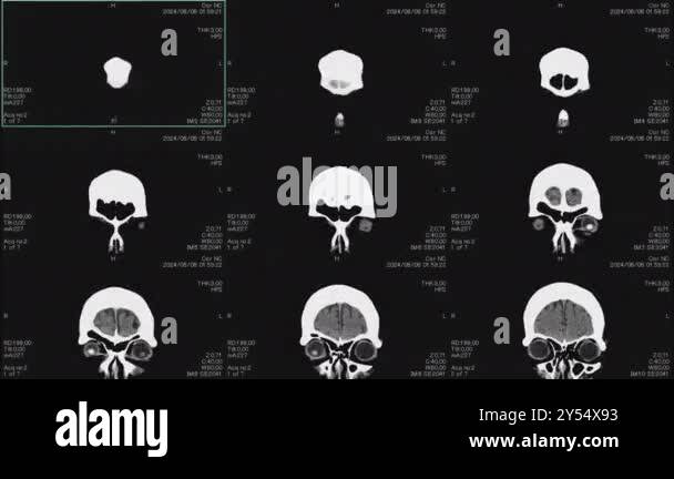 Magnetic resonance black and white images of the brain, top view, MRI ...