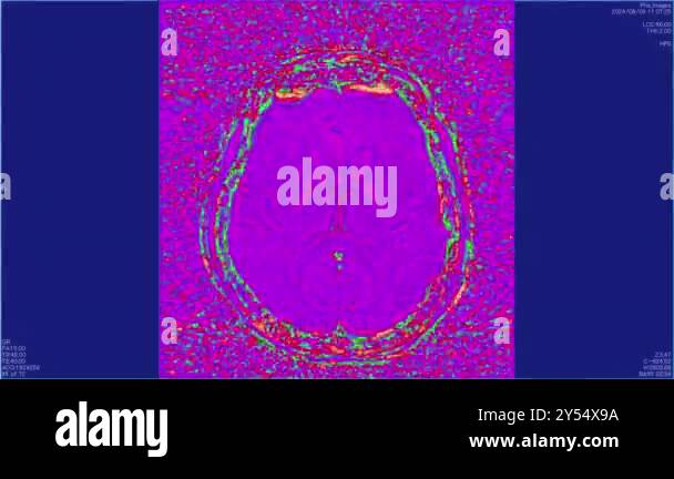 Magnetic resonance PHA images of the brain, MRI of the brain, of a ...