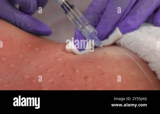 Treatment of decollete area skin by injection method, performed with ...