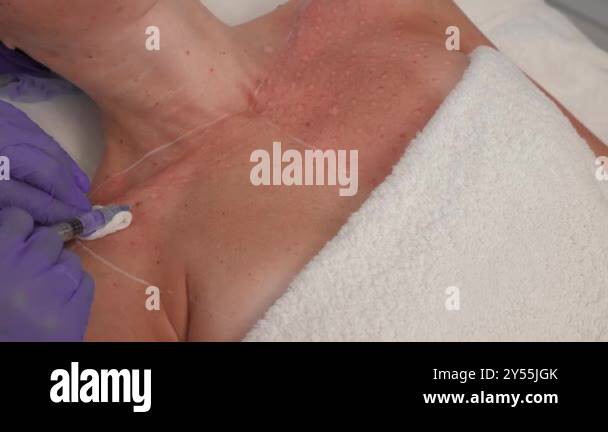 Treatment of decollete area skin by injection method, performed with ...