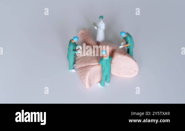 Miniature figures performing surgery on a huge lung model, representing ...